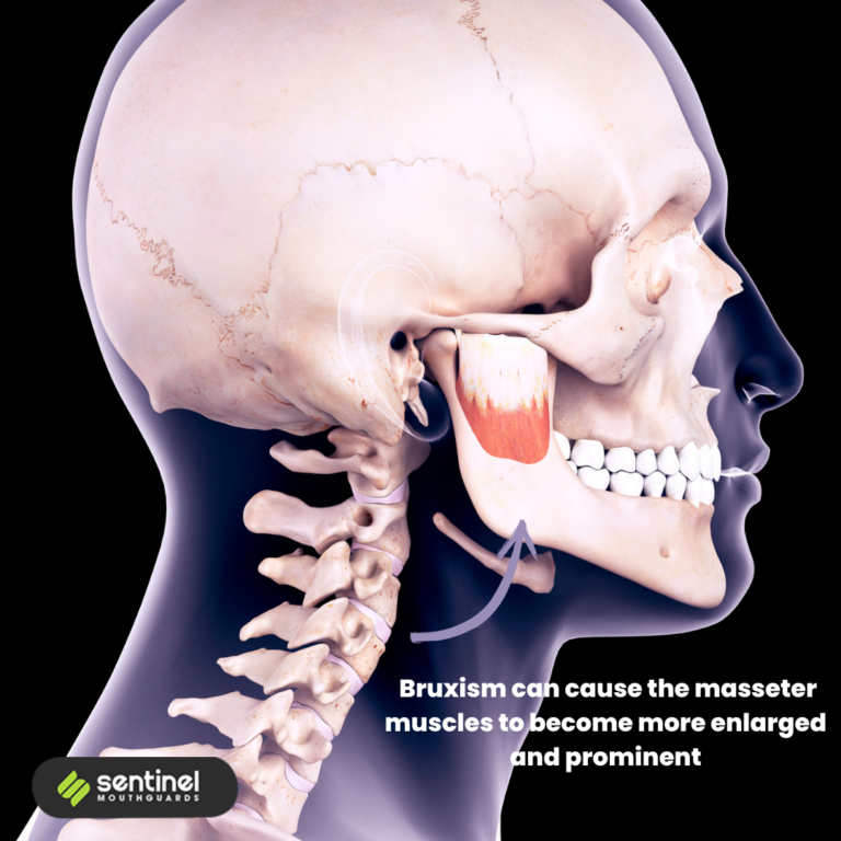 Can Grinding My Teeth Really Change Facial Features? | Sentinel ...